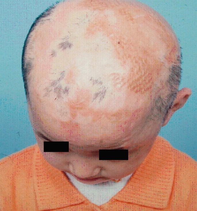 Reconstruction in Pediatric Burns | SpringerLink