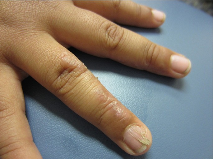 Lichen Striatus Affecting the Nail | Springer Nature Link
