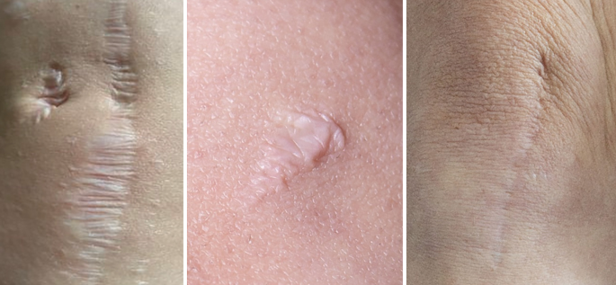 Classical Ehlers-Danlos Syndrome | SpringerLink