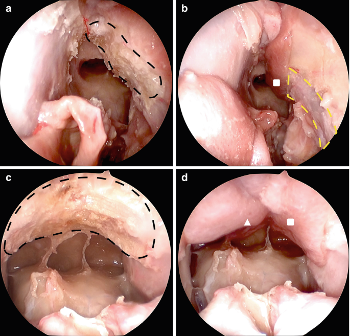 The Superior Lateral Anterior Pedicled Flap (SLAP) for the Draf III ...