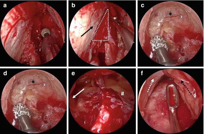 The Outside-in Draf III Procedure | SpringerLink