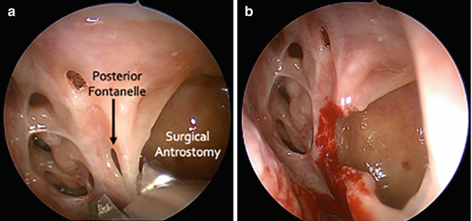 In-Office Endoscopic Sinus Surgery for Recalcitrant Chronic ...
