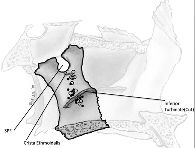Cryoablation and Radiofrequency Ablation of Posterior Nasal Nerve ...