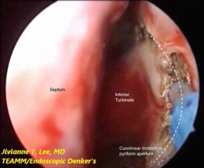 Endoscopic Denker’s Approach | SpringerLink