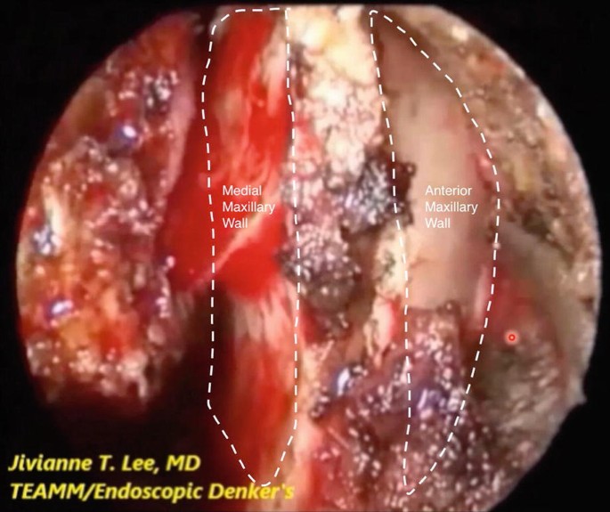 Endoscopic Denker’s Approach | SpringerLink