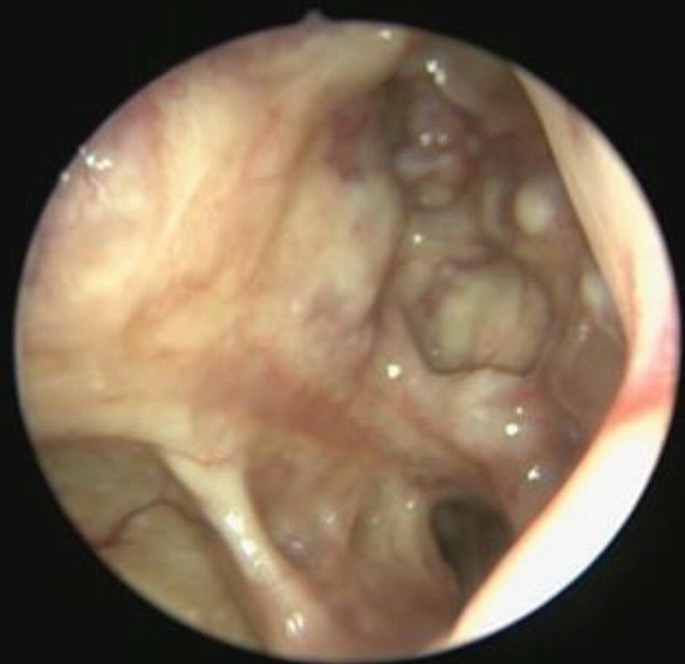 The Reboot Procedure for Severe Chronic Rhinosinusitis with Nasal ...