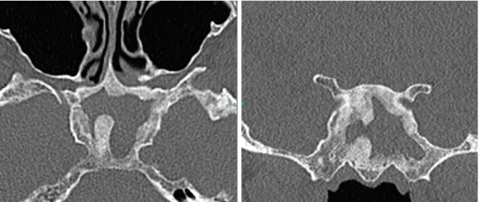 Sphenoid Drill-out for Recalcitrant Chronic Sphenoid Rhinosinusitis ...