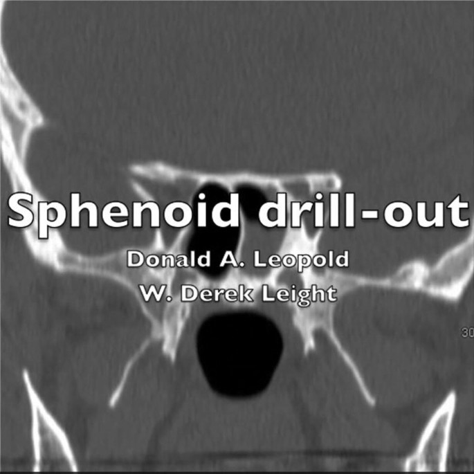 Sphenoid Drill-out for Recalcitrant Chronic Sphenoid Rhinosinusitis ...