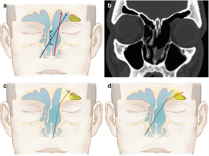 Modified Mini/Hemi/Subtotal/Central Lothrop for Recalcitrant Chronic ...
