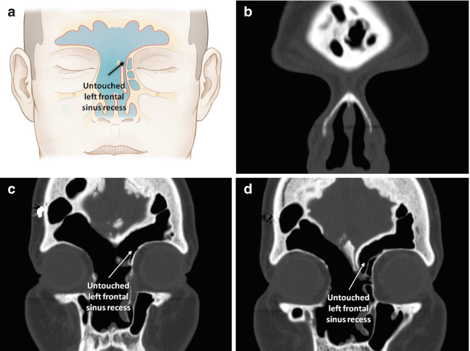 Modified Mini/Hemi/Subtotal/Central Lothrop for Recalcitrant Chronic ...