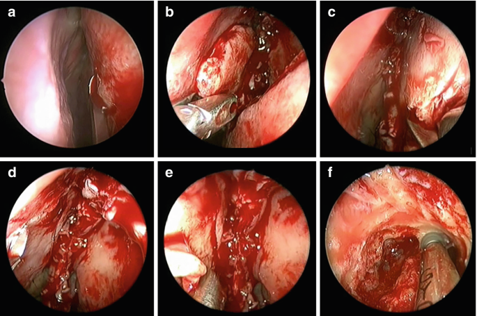 Draf III: Overall Concepts and the Mucosal Graft and Laterally Based ...