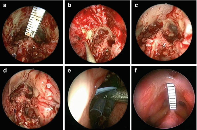 Draf III: Overall Concepts and the Mucosal Graft and Laterally Based ...