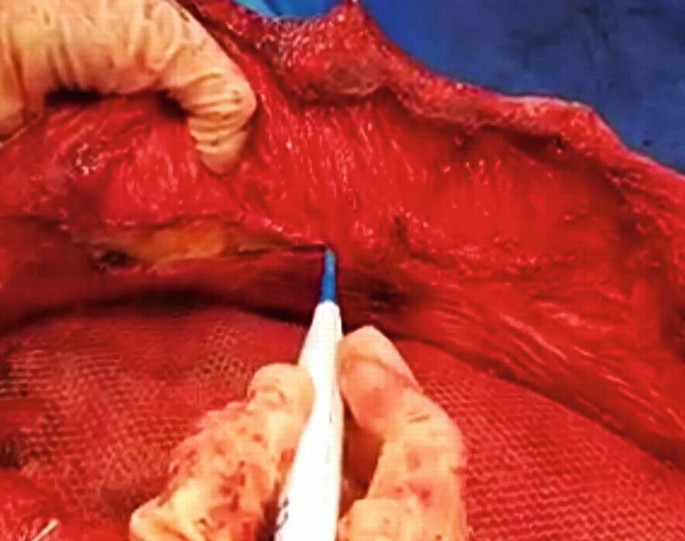 Transversus Abdominis Muscle Release: The TAR Procedure | SpringerLink