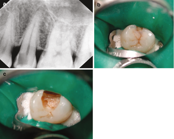 Minimally Invasive Dentistry | SpringerLink