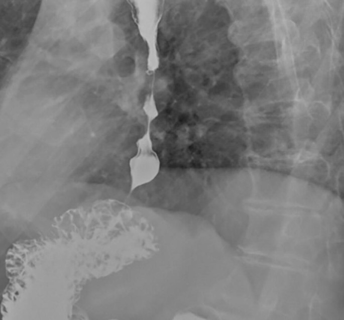 Radiological Evaluation of Functional Diseases of the Esophagus ...