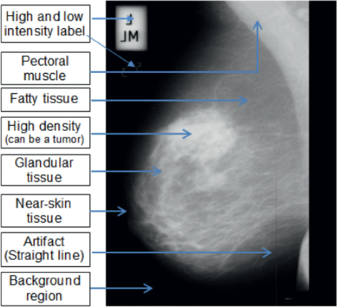 Toward an Enhanced Approach for Pectoral Muscle Segmentation in MLO ...