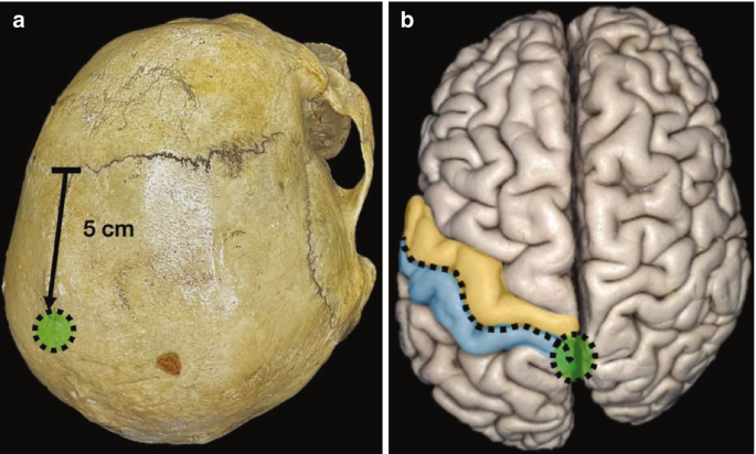 Dissecting the Brain Surface | SpringerLink