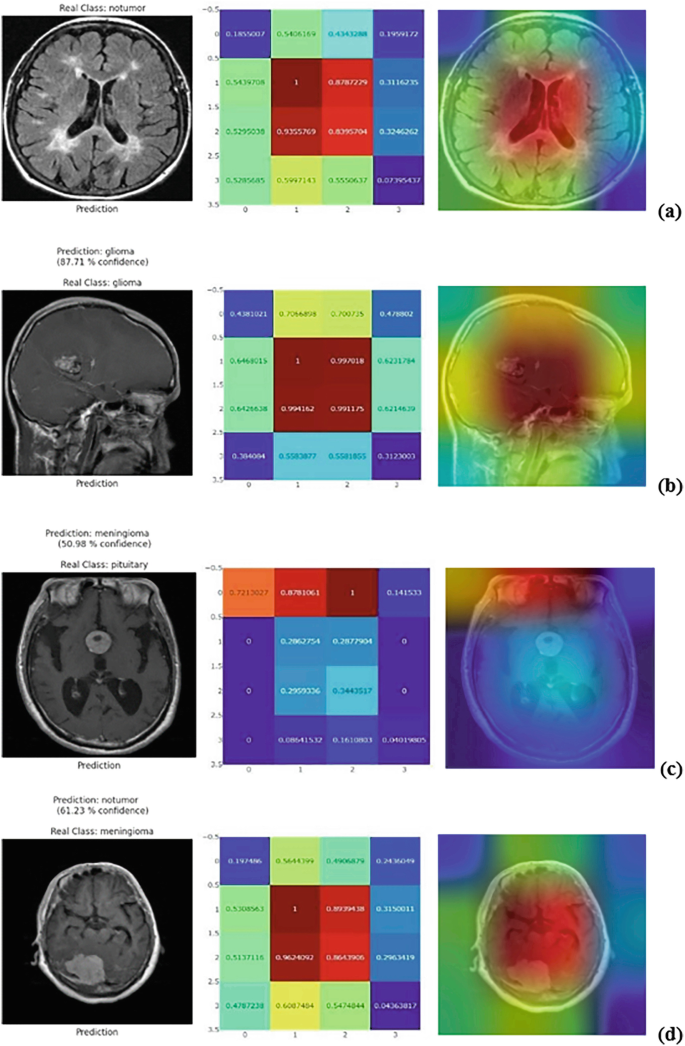 Interpreting Convolutional Neural Networks for Brain Tumors: A ...