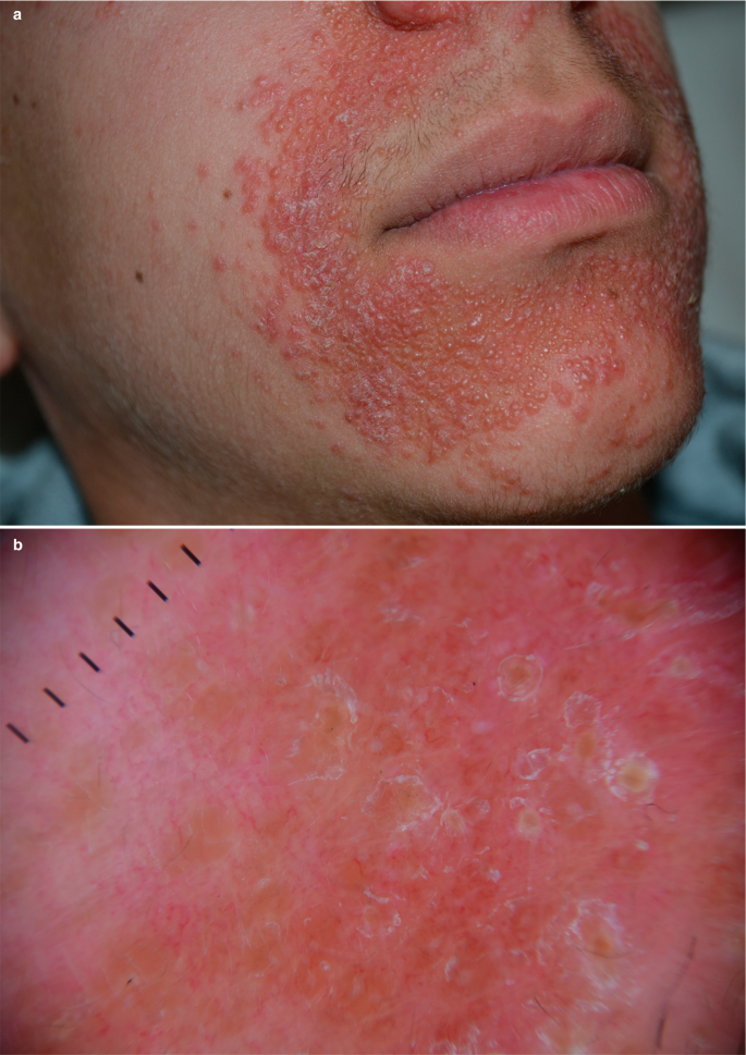 Childhood Granulomatous Periorificial Dermatitis | Springer Nature Link ...