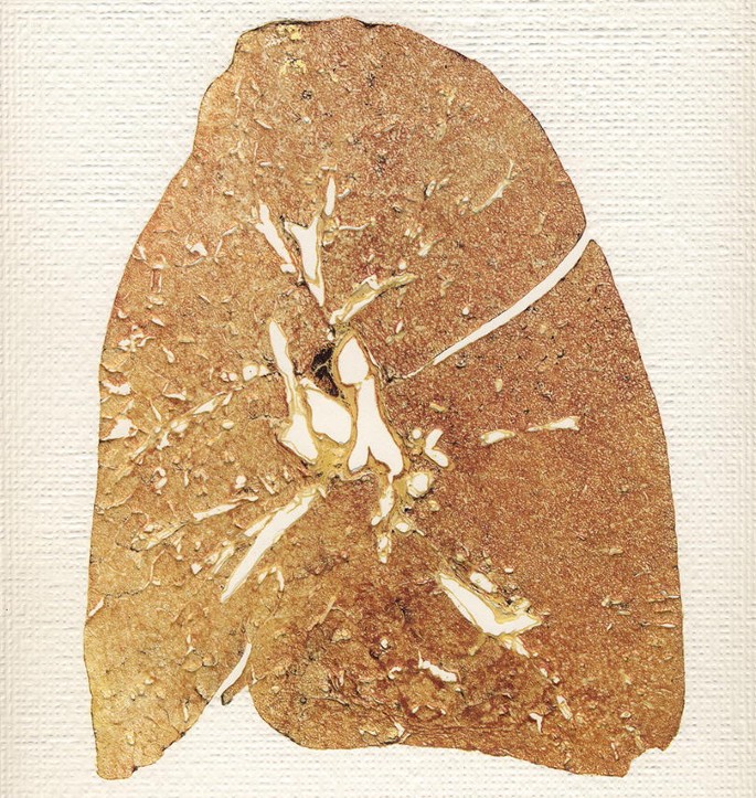 Normal Lung | SpringerLink