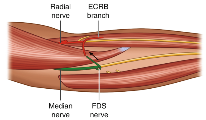 Flexor Digitorum Superficialis Branch of the Median Nerve to the ...