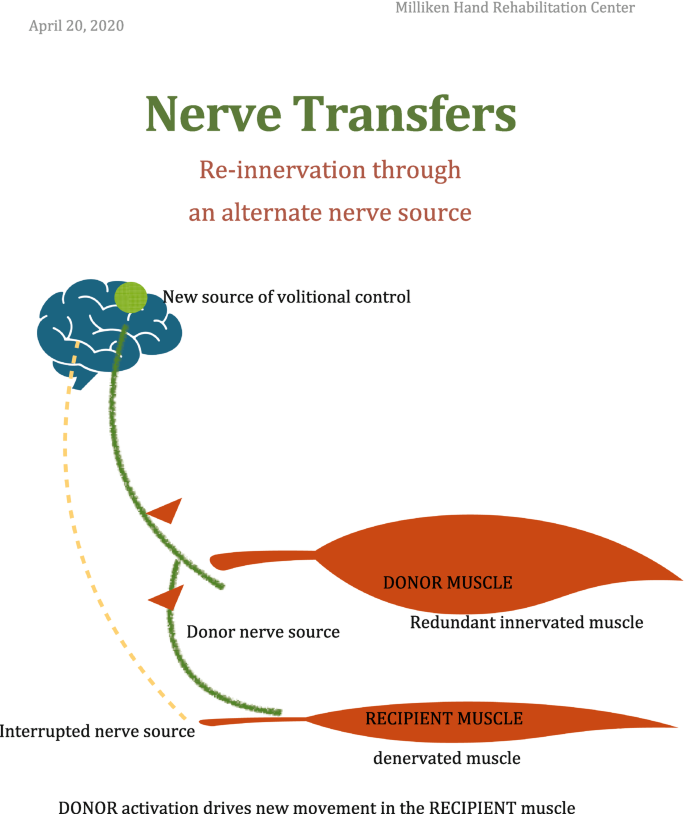 Rehabilitation Following Nerve Transfers in the Brachial Plexus ...