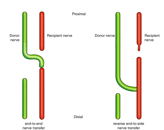 Rehabilitation Following Nerve Transfers in the Brachial Plexus ...