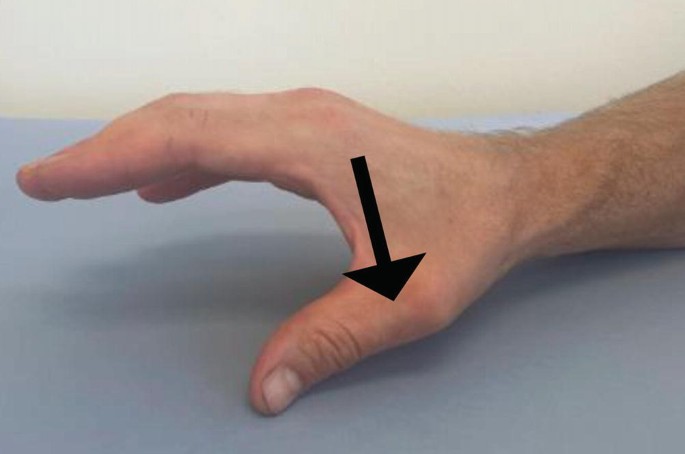 Opponens Pollicis Branch of the Median Nerve to First Dorsal Interossei ...
