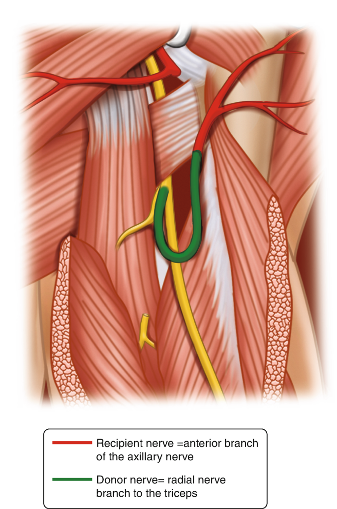 Radial Nerve Branch to the Triceps to Axillary Nerve Transfer ...