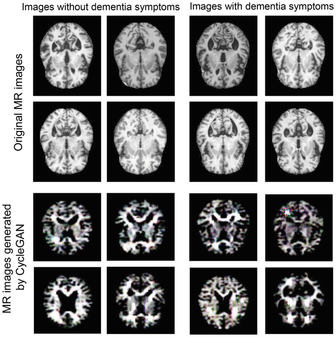 Computer-Aided Alzheimer’s Disease Diagnosis from Magnetic Resonance ...