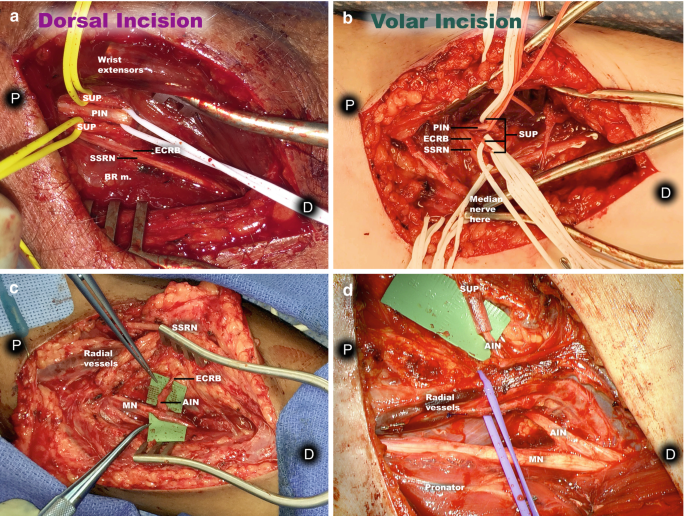 Anterior Interosseous Nerve Transfers for Restoration of Pinch and Grip ...