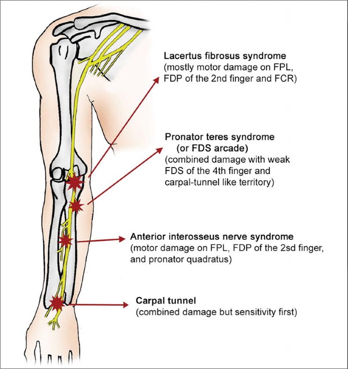 Entrapment Syndromes of the Median Nerve | Springer Nature Link ...