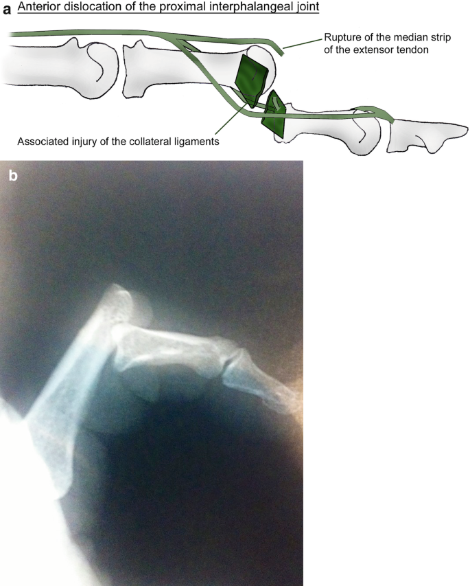 Capsulo-ligamentous Injuries of the Proximal Interphalangeal Joint ...