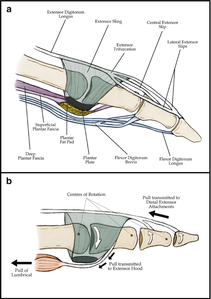 Surgery of the Lesser Toes | Springer Nature Link (formerly SpringerLink)