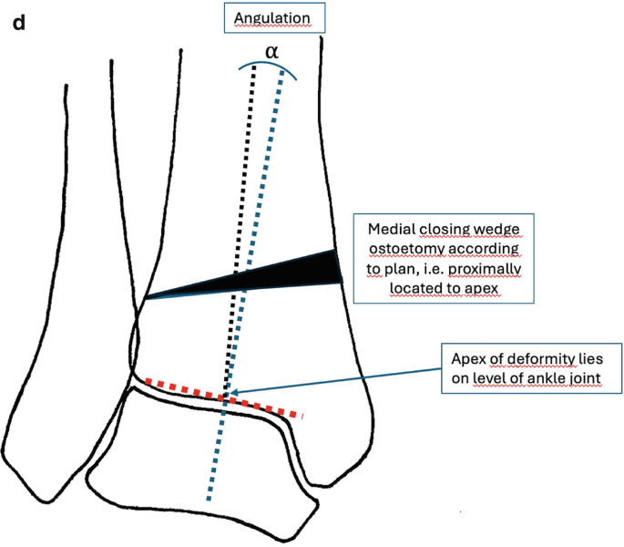 Joint Preserving Surgery in the Treatment of Ankle Osteoarthritis ...