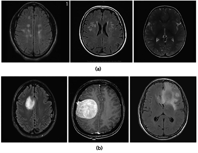 A Combination of CNN and Fuzzy Transform Framework for Accurate Brain ...