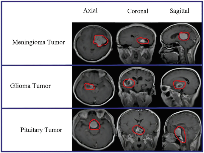 A Combination of CNN and Fuzzy Transform Framework for Accurate Brain ...