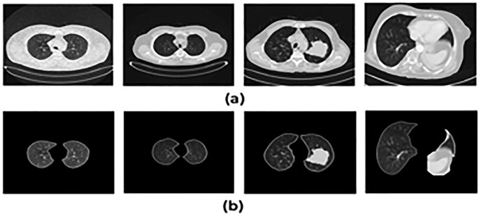 Optimized Deep Learning Framework for Lung Cancer Detection in Computed ...
