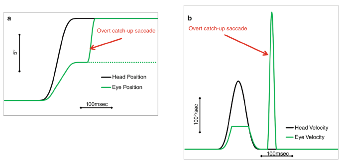 Video Head Impulse Testing | Springer Nature Link