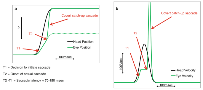 Video Head Impulse Testing | Springer Nature Link