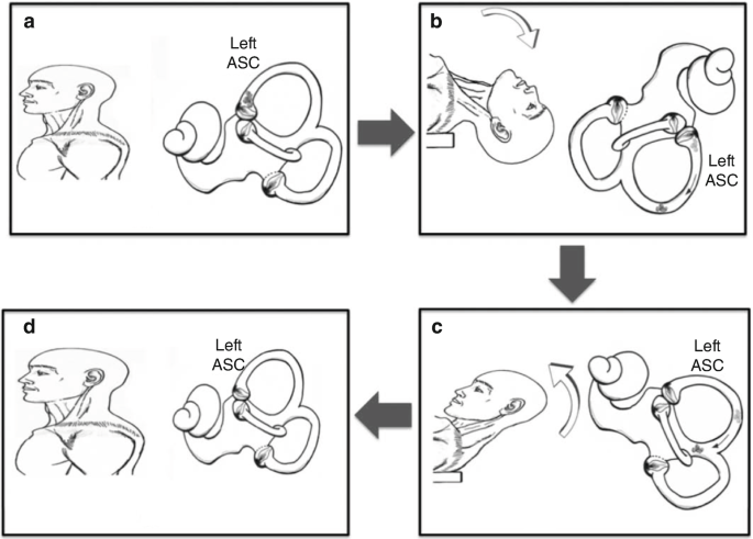 Anterior (Superior) Canal BPPV, Bilateral, or Side Unknown | Springer ...