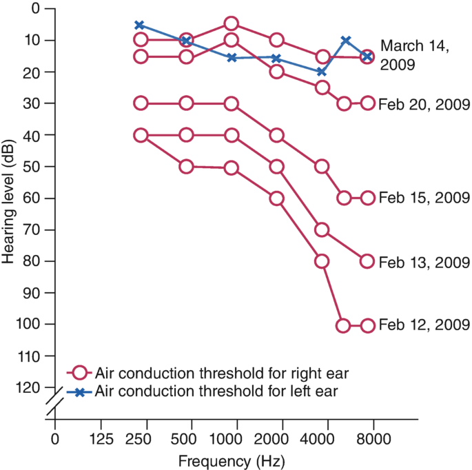 Sudden Sensorineural Hearing Loss (SSNHL) | Springer Nature Link