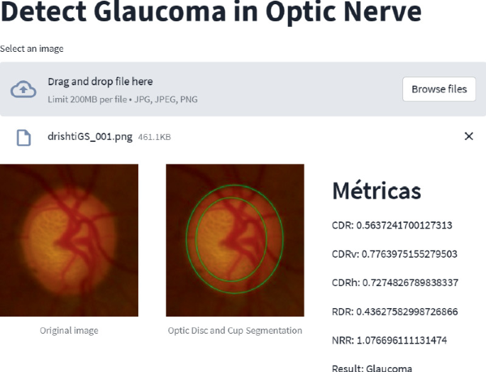 Optic Disc and Optic Cup Image Segmentation for Glaucoma Detection ...