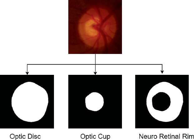 Optic Disc and Optic Cup Image Segmentation for Glaucoma Detection ...