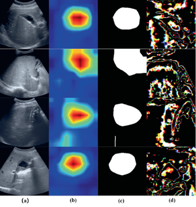 GallNet: A Hybrid Architecture for Gallbladder Cancer Detection ...