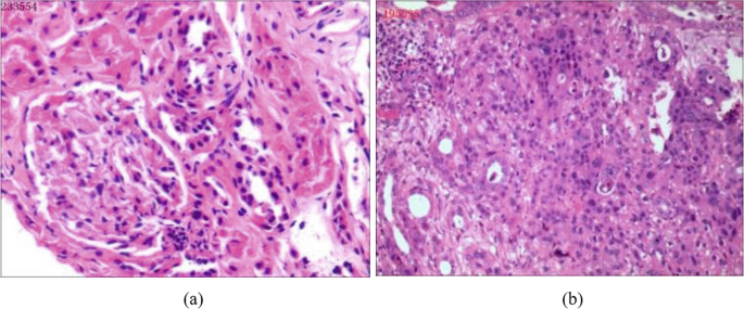 A Novel Method for Detecting Renal Cancer in Histopathology Images ...