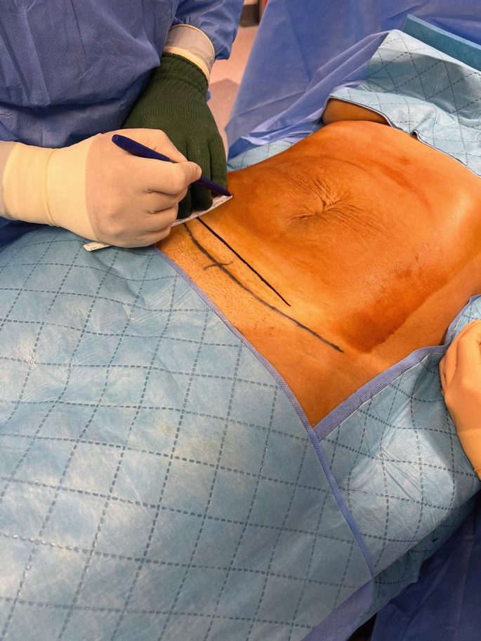 Abdominal Surgery Rehabilitation