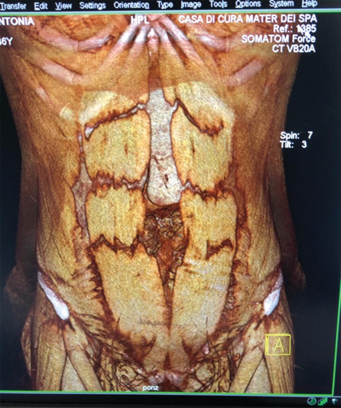 Anatomy of Abdominal Wall | SpringerLink