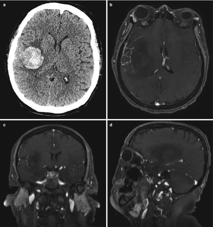 Preoperative MRI-DTI: Contribution to Surgical Planning | Springer ...