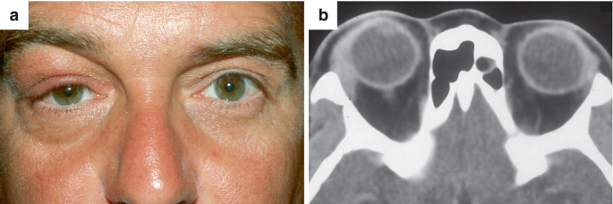 Lacrimal Gland Tumors | Springer Nature Link